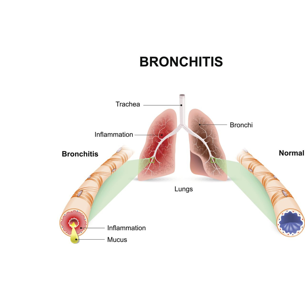 Acute Bronchitis Harvard Health Acute Bronchitis Harvard Health