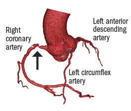 A safer way to diagnose coronary artery disease? - Harvard Health