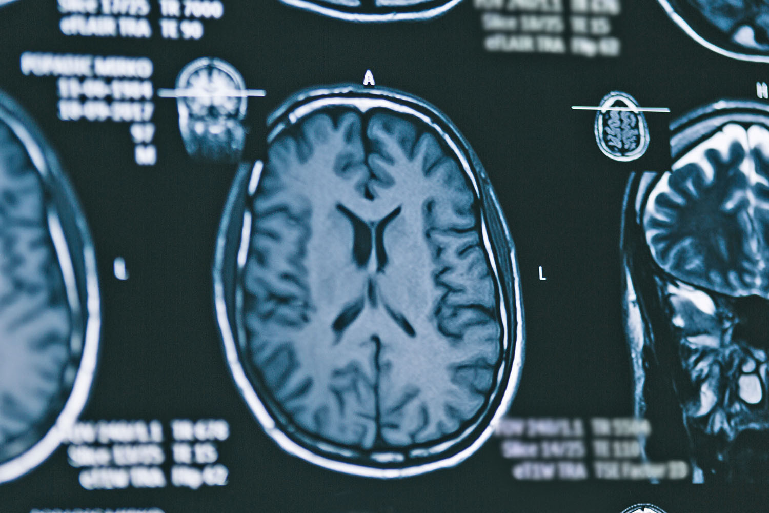 Do blood tests really help diagnose Alzheimer's disease? - Harvard Health