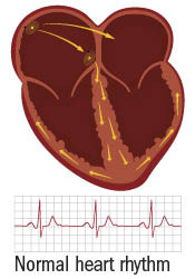 What happens during electrical cardioversion? - Harvard Health